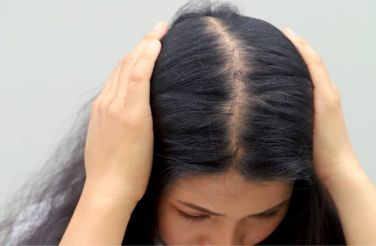Telogen Effluvium Causes & Triggers | Telogen Effluvium